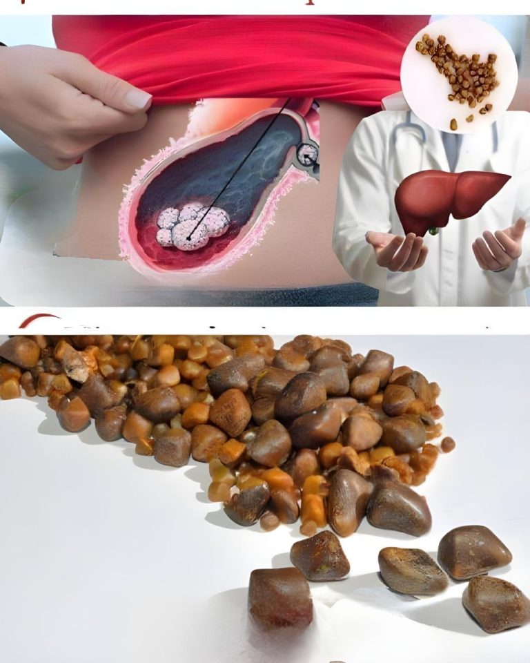 Cómo Eliminar Las Piedras En Los Riñones De Forma Natural Guía Completa Para Tu Bienestar Renal